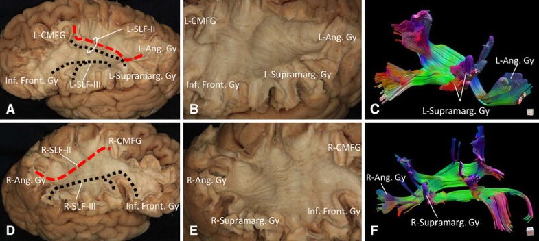 Subcomponents and connectivity of the superior longitudinal fasciculus ...