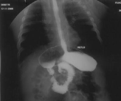 Gastric organo-axial malrotation coexisting respiratory symptoms ...