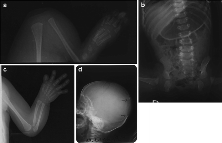 Brachyphalangy, polydactyly and tibial aplasia/hypoplasia syndrome (OMIM 609945): case report ...