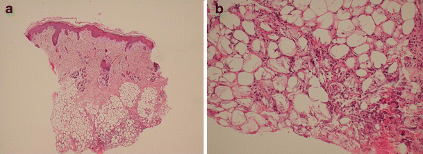 Subcutaneous fat necrosis in newborn—an unusual case and review of ...
