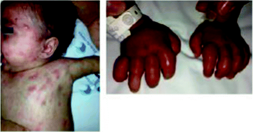 CANDLE syndrome: chronic atypical neutrophilic dermatosis with ...