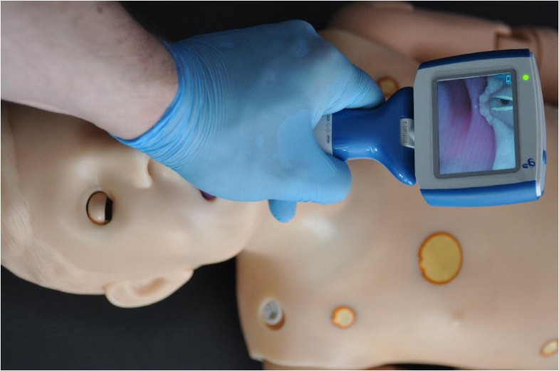 Comparison of Miller laryngoscope and UEScope videolaryngoscope for ...