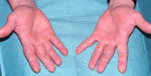 Acrokeratosis paraneoplastica of Bazex as an indicator for underlying ...
