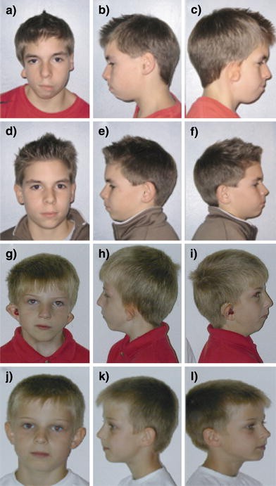 Reproduction abnormalities and twin pregnancies in parents of sporadic ...