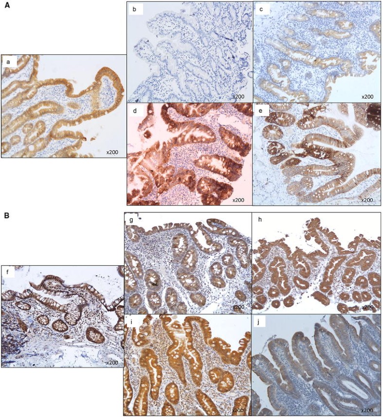 Genetic characterization of congenital tufting enteropathy: epcam ...