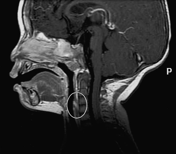 Postcricoid Hemangioma: An Overlooked Cause of Dysphagia in Infants?–A ...