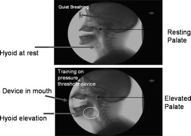 Surface Electromyographic Activity of the Submental Muscles During ...