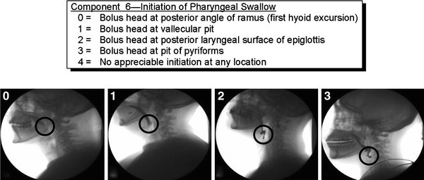 MBS Measurement Tool for Swallow Impairment—MBSImp: Establishing a ...