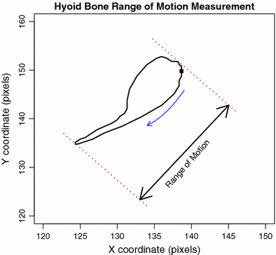 Computer-Assisted Assessment of Hyoid Bone Motion from ...