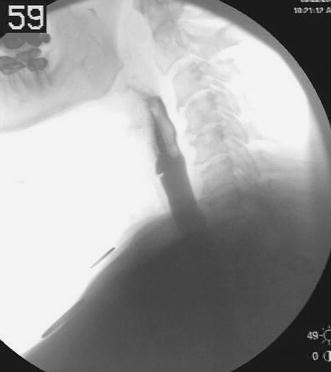 Posterior Cricoid Region Fluoroscopic Findings: The Posterior Cricoid ...