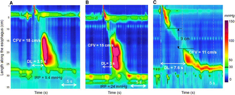 Distal Esophageal Spasm | SpringerLink