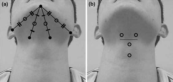 Kinematic Effects of Hyolaryngeal Electrical Stimulation Therapy on ...