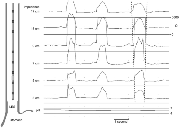 Speech Therapy as Treatment for Supragastric Belching | SpringerLink