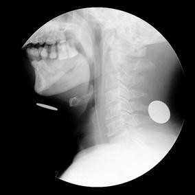 Effect of Nasogastric Tube on Aspiration Risk: Results from 147 ...