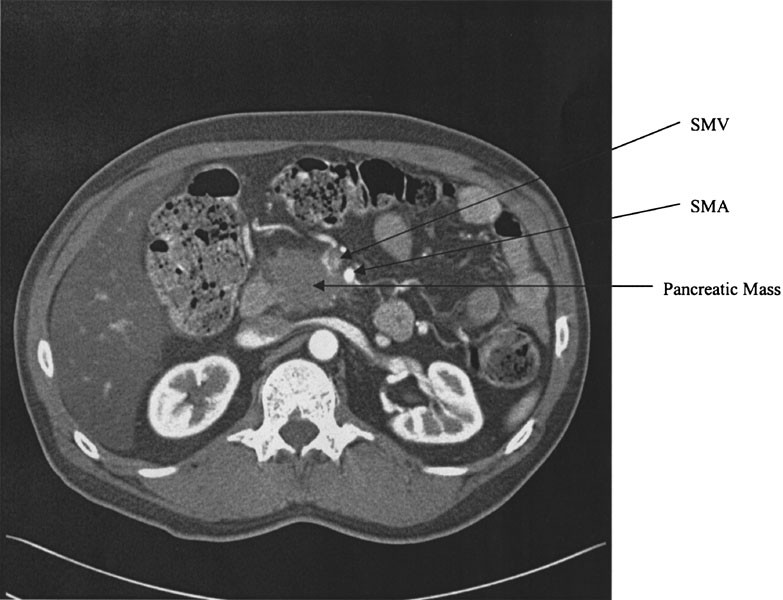 Imaging for the diagnosis and staging of periampullary carcinomas ...