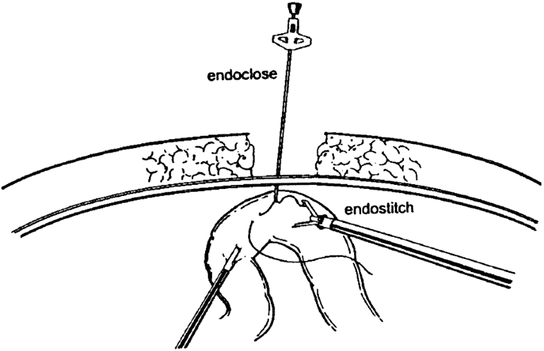 Laparoscopic feeding jejunostomy: A systematic review | SpringerLink