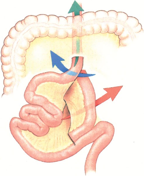Symptomatic internal hernias after laparoscopic bariatric surgery ...