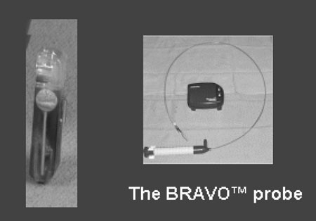 Bravo capsule induction of esophageal hypercontractility and chest pain ...