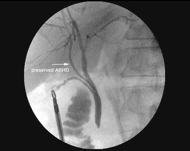 The “inside approach of the gallbladder” is an alternative to the ...