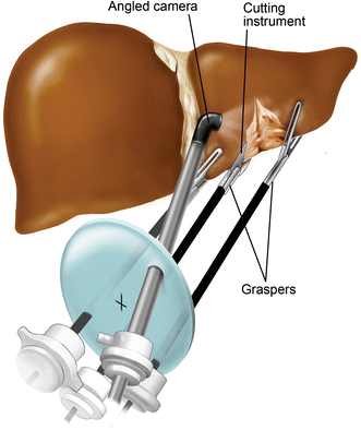 Single-incision laparoscopic liver resection | SpringerLink