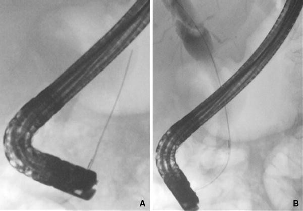 A new guidewire cannulation technique in ERCP: successful deep biliary ...