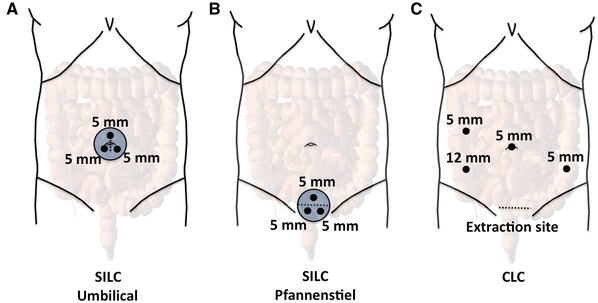 Single-incision versus conventional laparoscopic sigmoid colectomy: a ...
