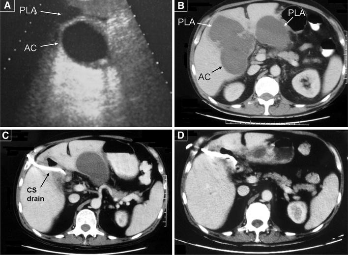 Synchronous pyogenic liver abscess and acute cholecystitis: how to ...