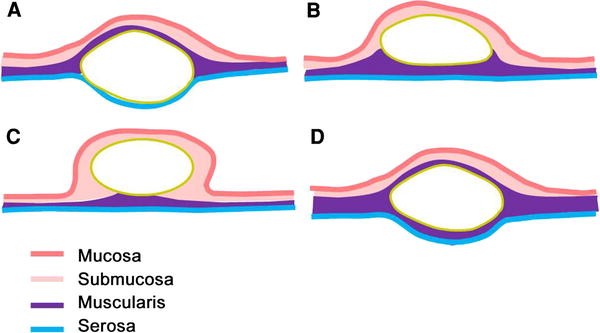 Endoscopic submucosal dissection as a treatment for gastric ...