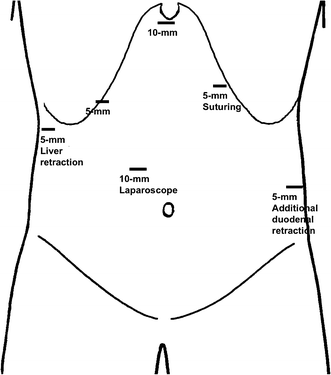 Laparoscopic bile duct exploration via choledochotomy followed by ...