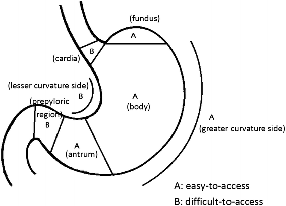 Laparoscopic resection for large gastric gastrointestinal stromal tumor ...