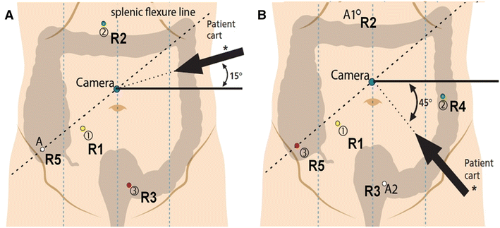 Robotic left colon cancer resection: a dual docking technique that maximizes splenic flexure ...
