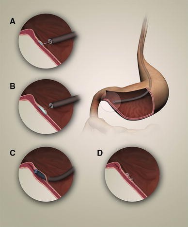 Assessment of the length of myotomy in peroral endoscopic pyloromyotomy ...