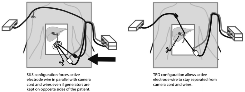 Single-incision laparoscopic surgery increases the risk of ...