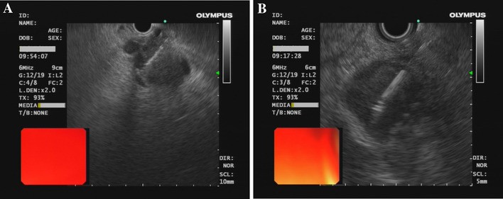 Evaluation of 22G fine-needle aspiration (FNA) versus fine-needle ...