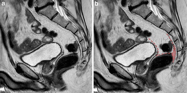 Residual mesorectum on postoperative magnetic resonance imaging ...