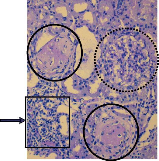 Treatment and outcome of Shiga-toxin-associated hemolytic uremic ...