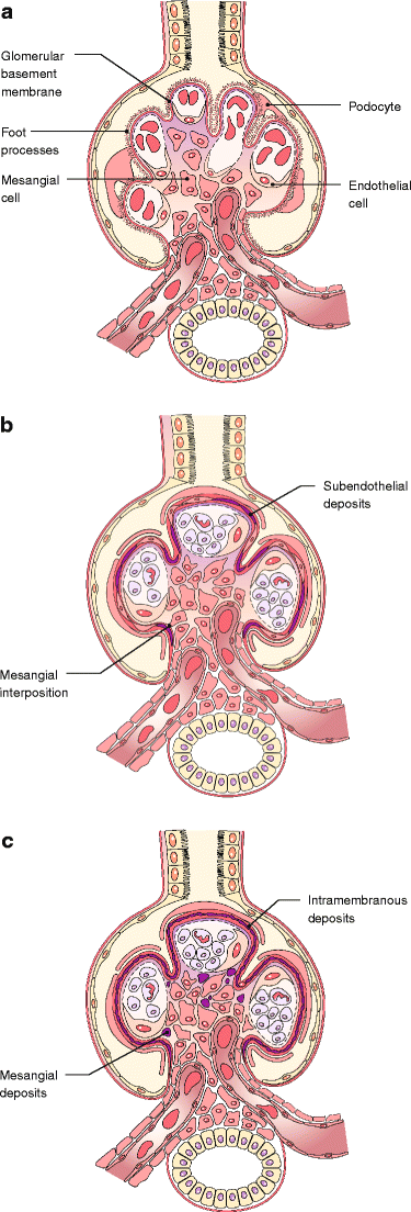 Membranoproliferative glomerulonephritis | SpringerLink