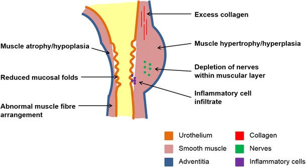 The molecular biology of pelvi-ureteric junction obstruction | SpringerLink