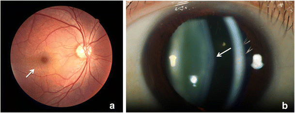 Renal, auricular, and ocular outcomes of Alport syndrome and their ...