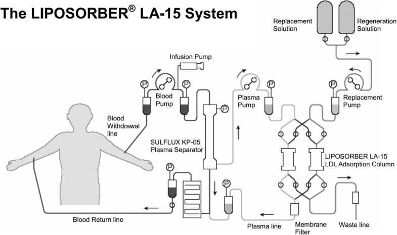 An update on LDL apheresis for nephrotic syndrome | SpringerLink