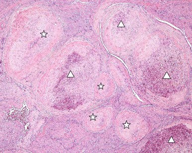 Subinvolution of placental bed vessels: case report and review of the ...