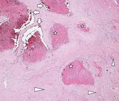 Subinvolution of placental bed vessels: case report and review of the ...