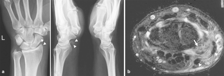 Intensive ultrasound treatment in acute calcific periarthritis of the ...