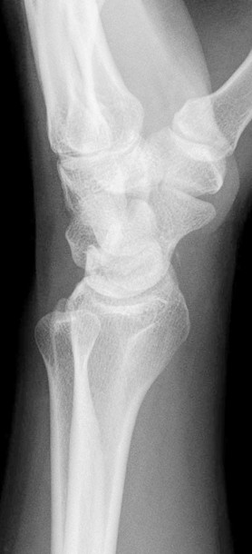 Intensive ultrasound treatment in acute calcific periarthritis of the ...