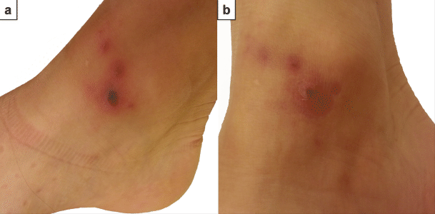 Molecular diagnosis of African tick bite fever using eschar swabs in a ...