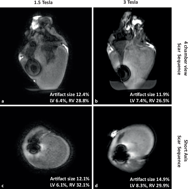 Visualization and appearance of artifacts of leadless pacemaker systems ...