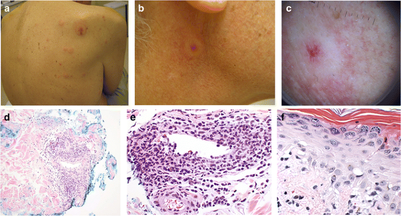 Ixazomib-induced cutaneous necrotizing vasculitis | SpringerLink