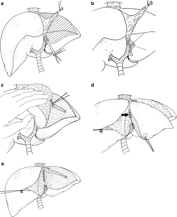 Segmentectomy of the liver | SpringerLink