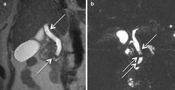 Preoperative MRCP to detect choledocholithiasis in acute calculous ...