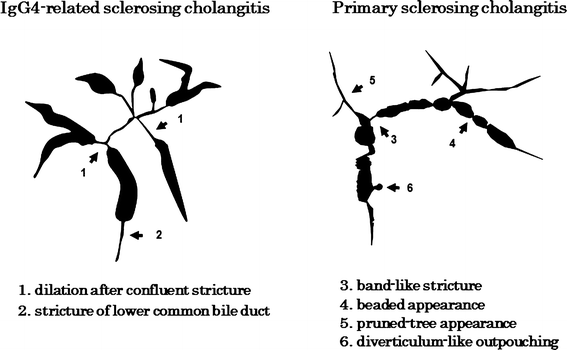 Clinical diagnostic criteria of IgG4-related sclerosing cholangitis ...